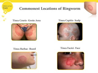 Ringworm Stages