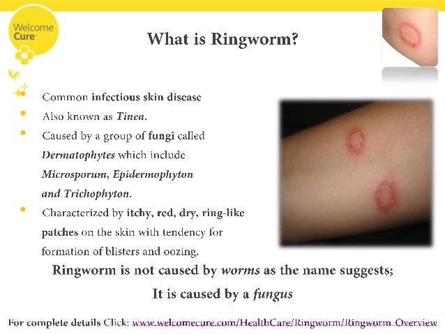 Treating Ringworm Infection, Achieving Flawless skin with Homeopathy! Treating Ringworm Infection, Achieving Flawless skin with Homeopathy!