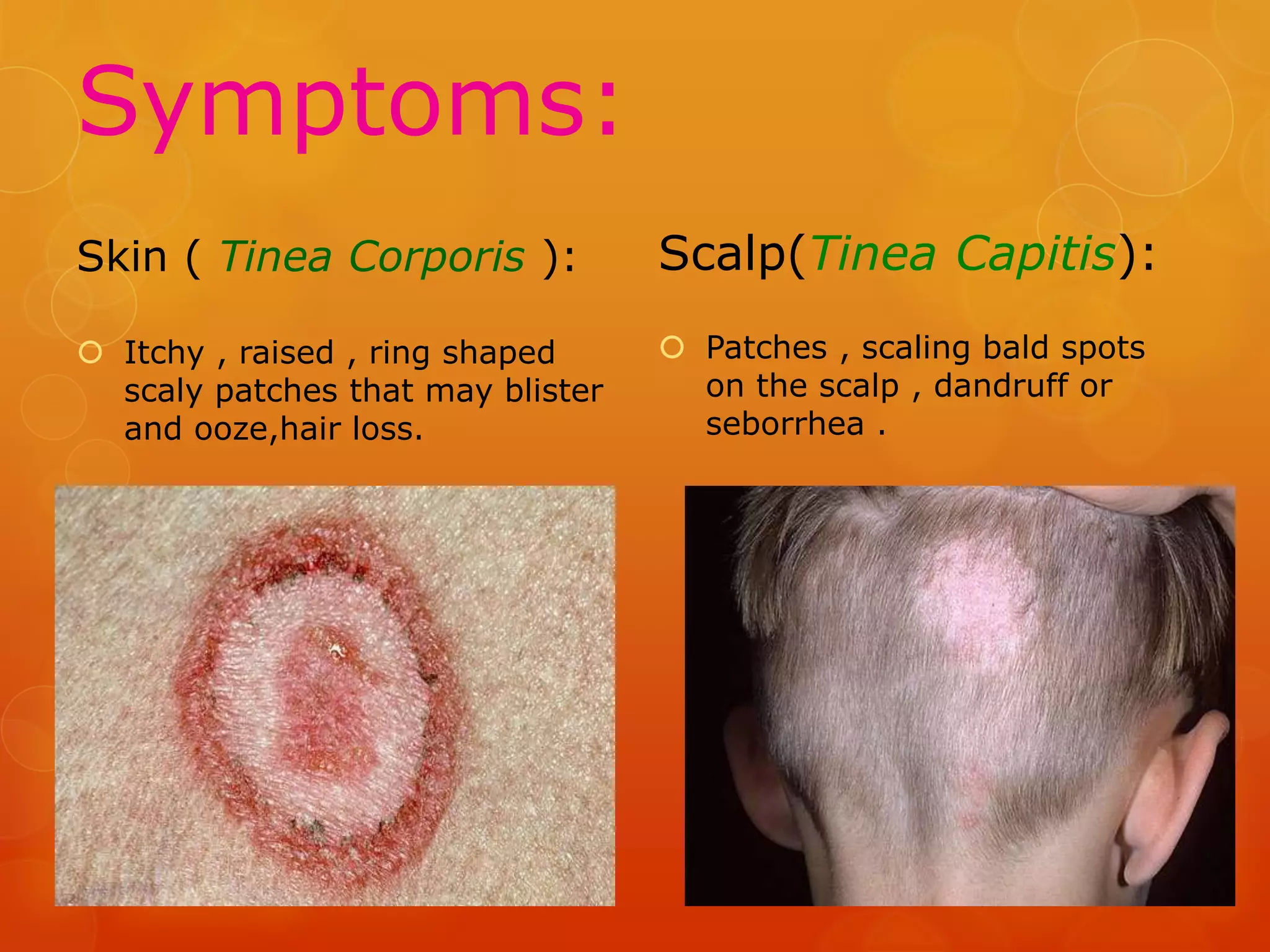 Ringworm | PPTX