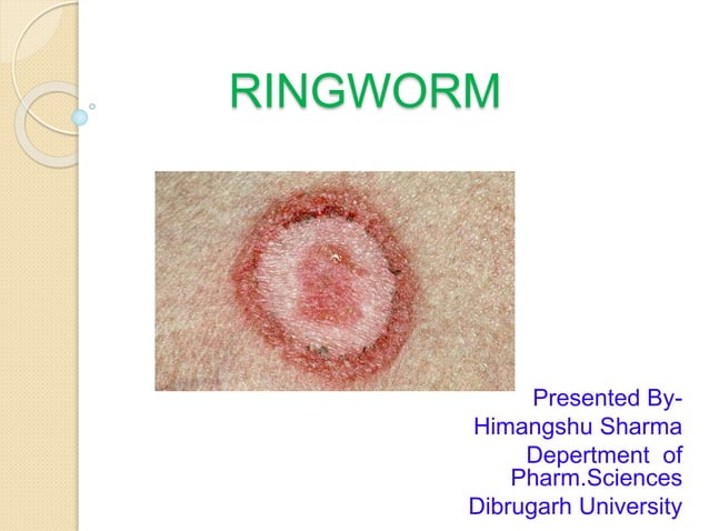 Ringworm | PPTX | Skin and Dermatology | Diseases and Conditions