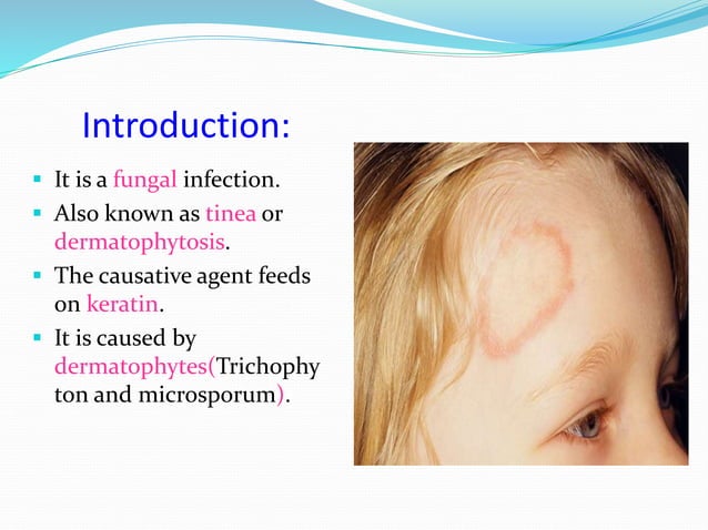 Ringworm | PPTX | Skin and Dermatology | Diseases and Conditions
