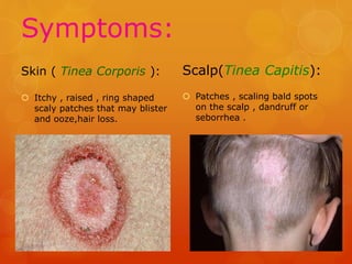 Ringworm | PPTX
