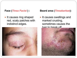 Tinea Faciei Beard