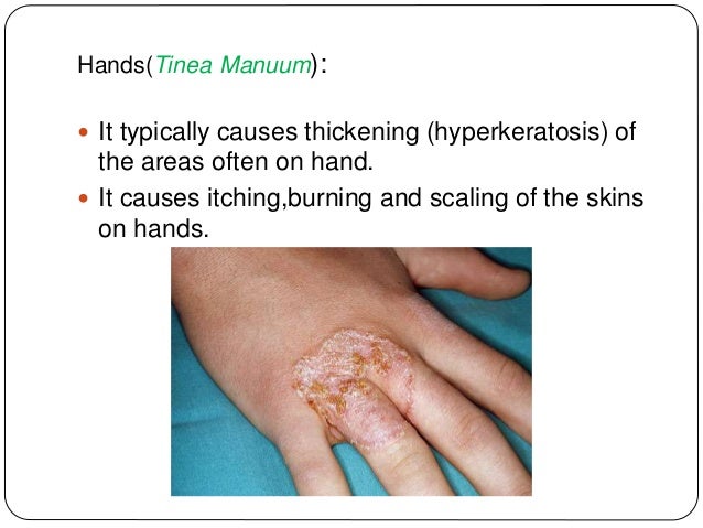 Ringworm On Hands Homeoinformation: Ringworm On Skin