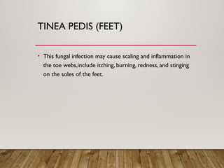 RingWorm Ringworm is a common fungal infection also known as Tinea | PPTX