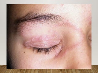 RingWorm Ringworm is a common fungal infection also known as Tinea | PPTX