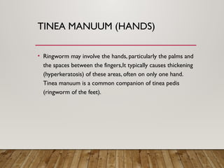 RingWorm Ringworm is a common fungal infection also known as Tinea | PPTX