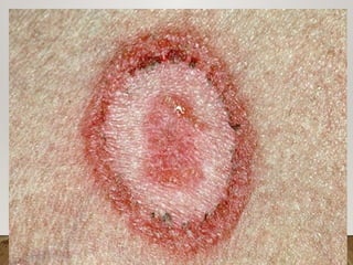 RingWorm Ringworm is a common fungal infection also known as Tinea | PPTX