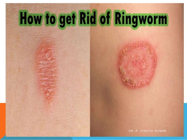 Ringworm Photograph By Dr P Marazziscience Photo Library