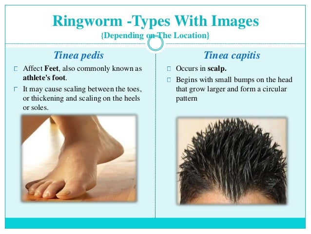Ringworm in Athletes