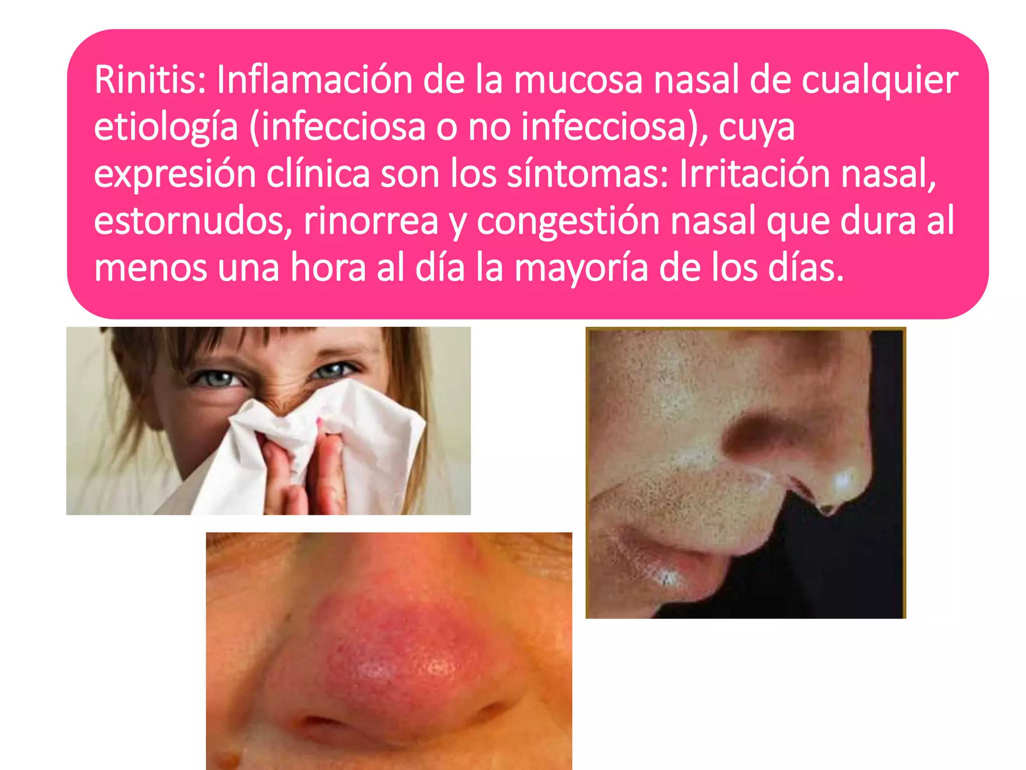 Rinitis | PPTX | Ear, Nose and Throat Conditions | Diseases and Conditions
