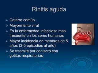 rinitis (1).pptx