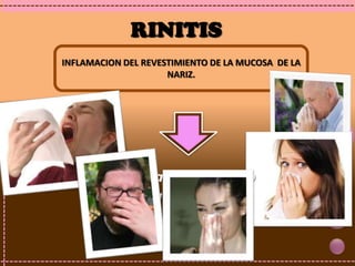 Rinitis alergica | PPTX