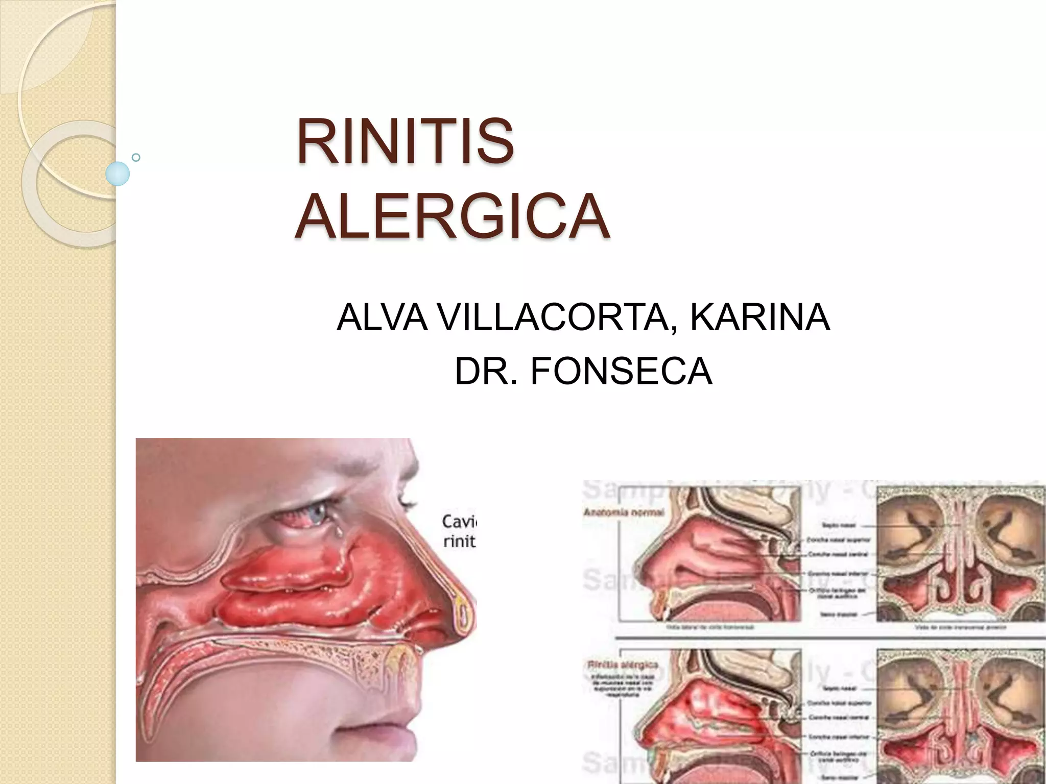 Rinitis alergica | PPTX