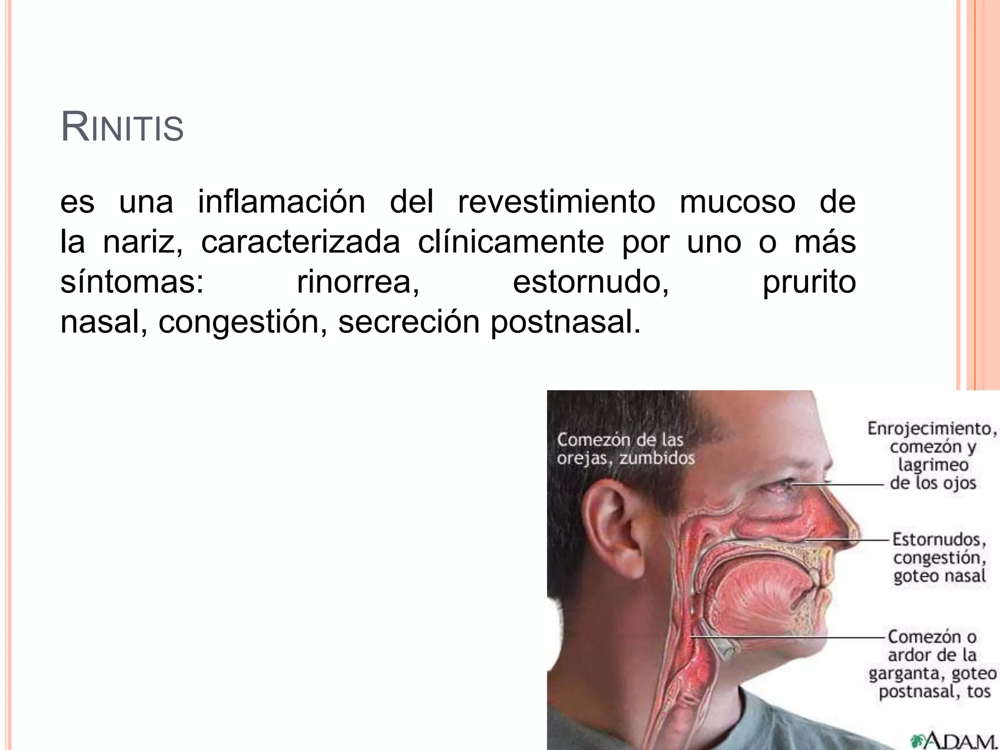 Rinitis alergica y no alergica | PPTX