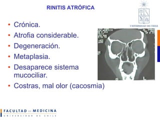 Rinitis atrófica | PPT