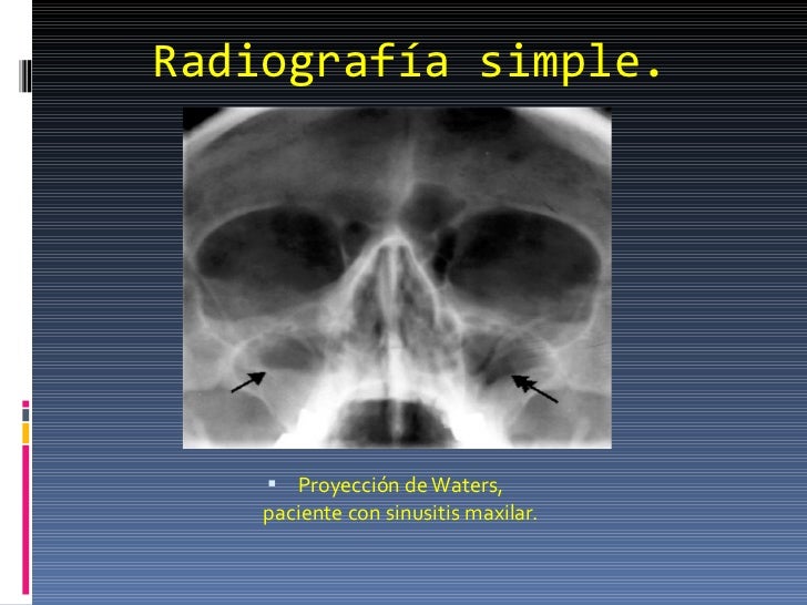 Rinitis y Rinosinusitis Dr. Casanova