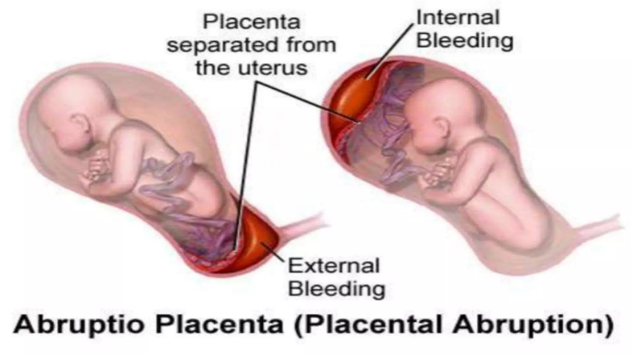 abruptio placenta | PPTX