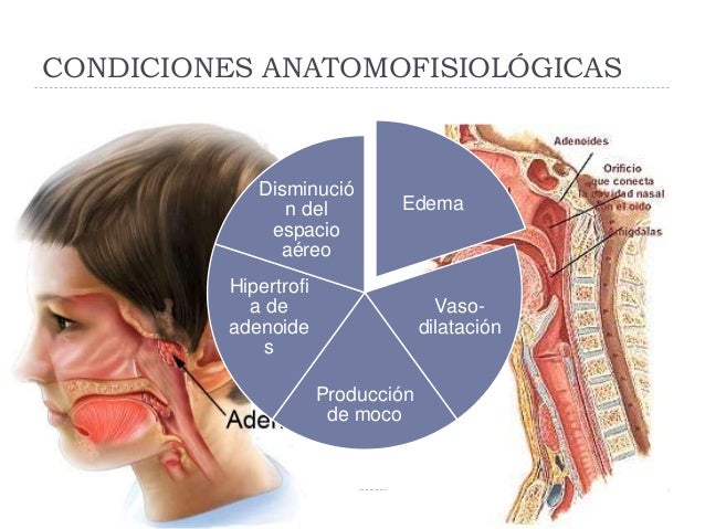 Rinofaringitis en Pediatría.