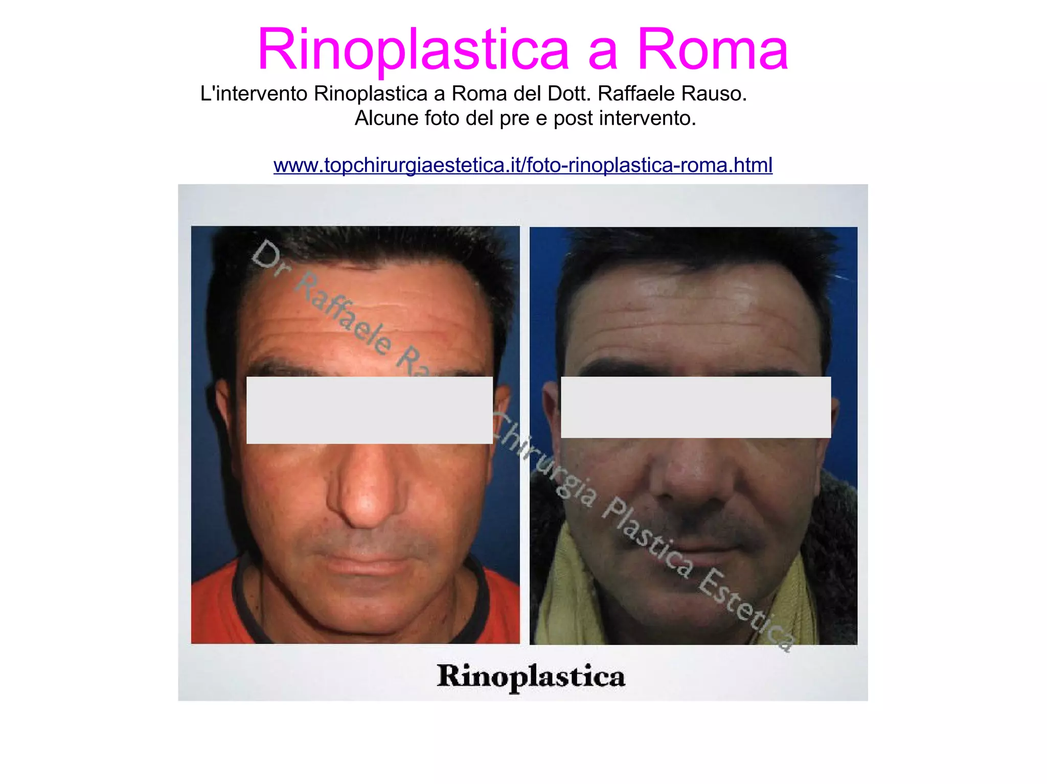 Rinoplastica Roma | Chirurgo Plastico Raffaele Rauso | PPT