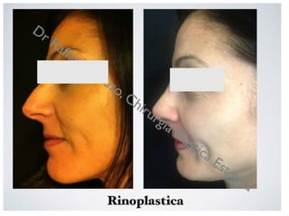 Rinoplastica Roma | Chirurgo Plastico Raffaele Rauso | PDF