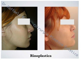 Rinoplastica Roma | Chirurgo Plastico Raffaele Rauso | PDF