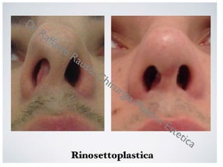 Rinoplastica Roma | Chirurgo Plastico Raffaele Rauso | PDF