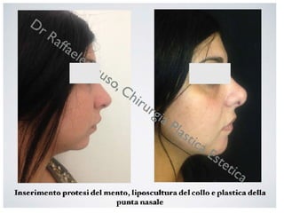 Rinoplastica Roma | Chirurgo Plastico Raffaele Rauso | PDF