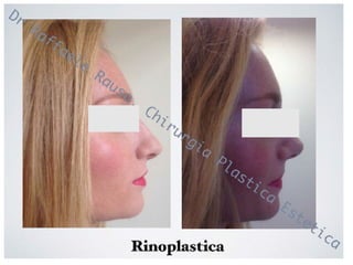Rinoplastica Roma | Chirurgo Plastico Raffaele Rauso | PDF