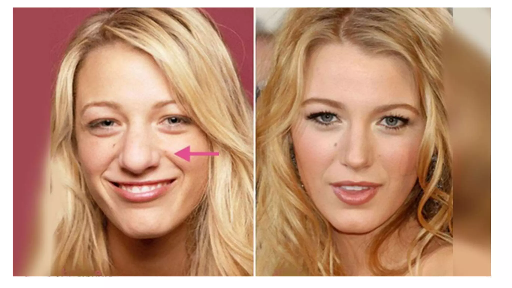 Rinoplastika un deguna rekonstrukcija | PPTX