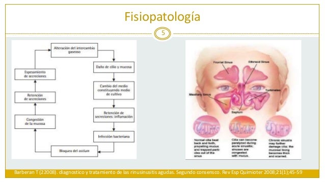 Rinosinusitis