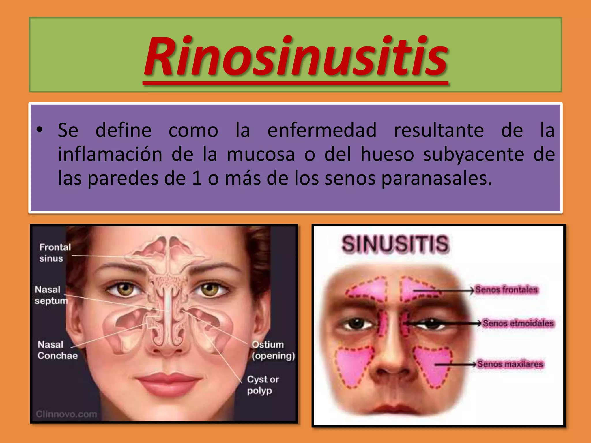 Rinosinusitis definitivo | PPT