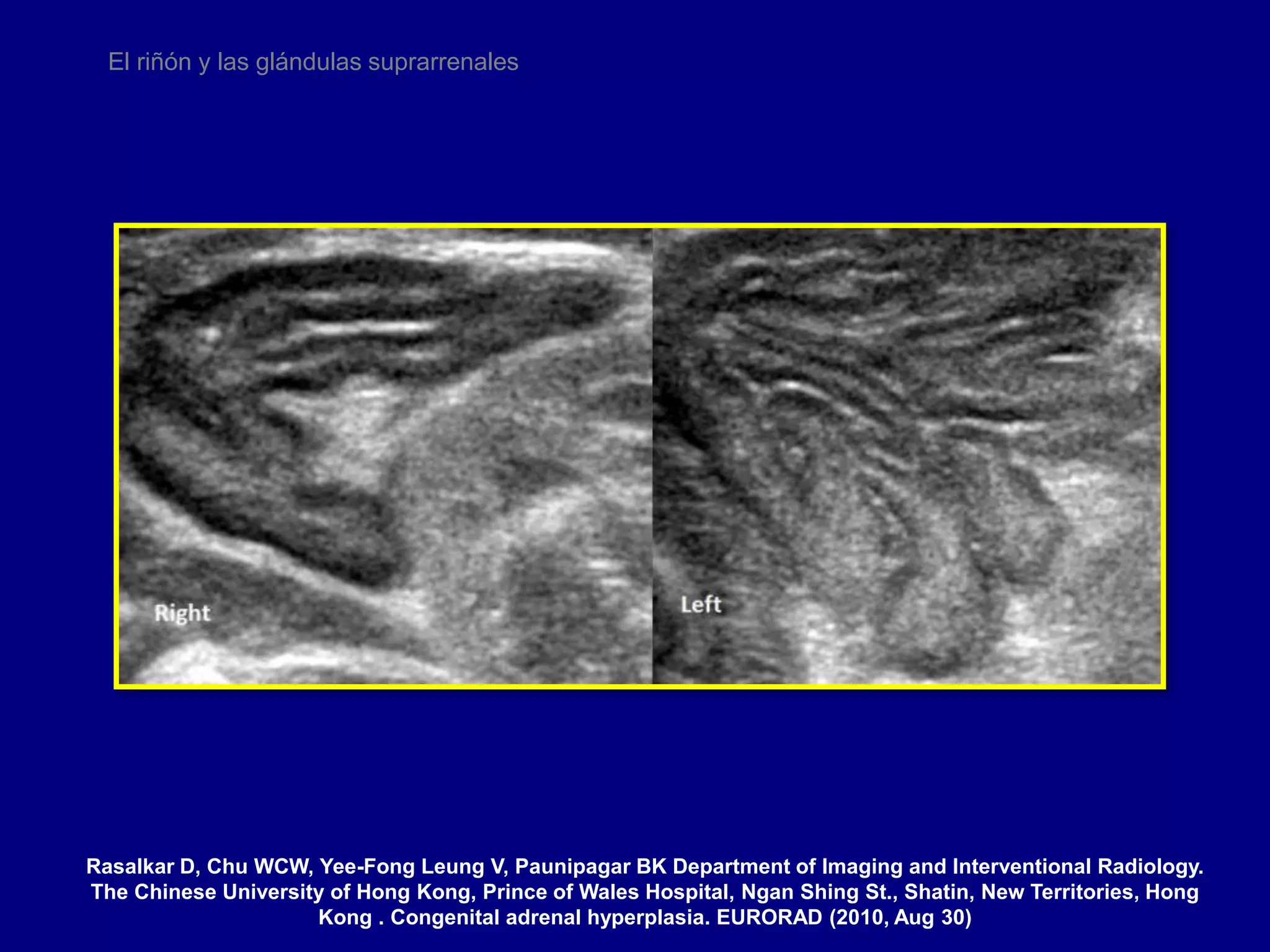 Riñon y glandula suprarrenal pediatrico | PPTX