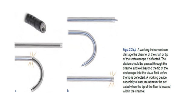 Flexible ureteroscopy and RIRS | PDF