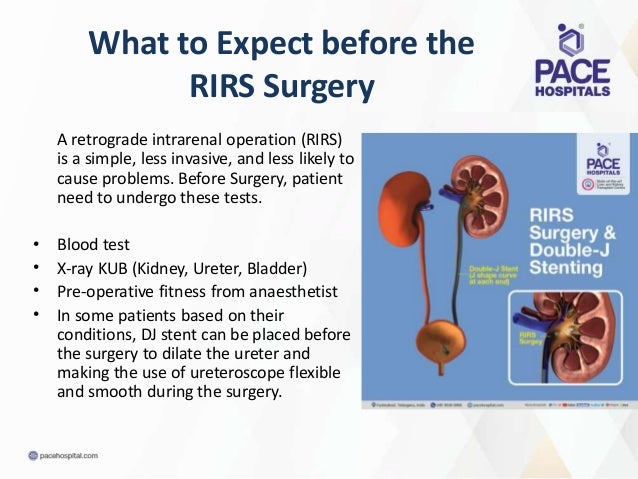 RIRS Surgery - Procedure & Benefits | PDF