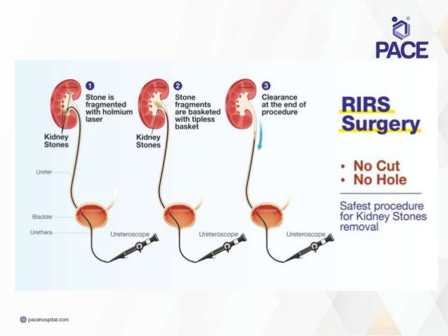 RIRS Surgery - Procedure & Benefits | PDF