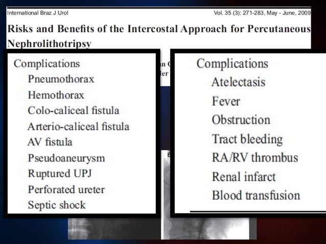 RIRS VS PNL (2) point counter point ppt | PPT