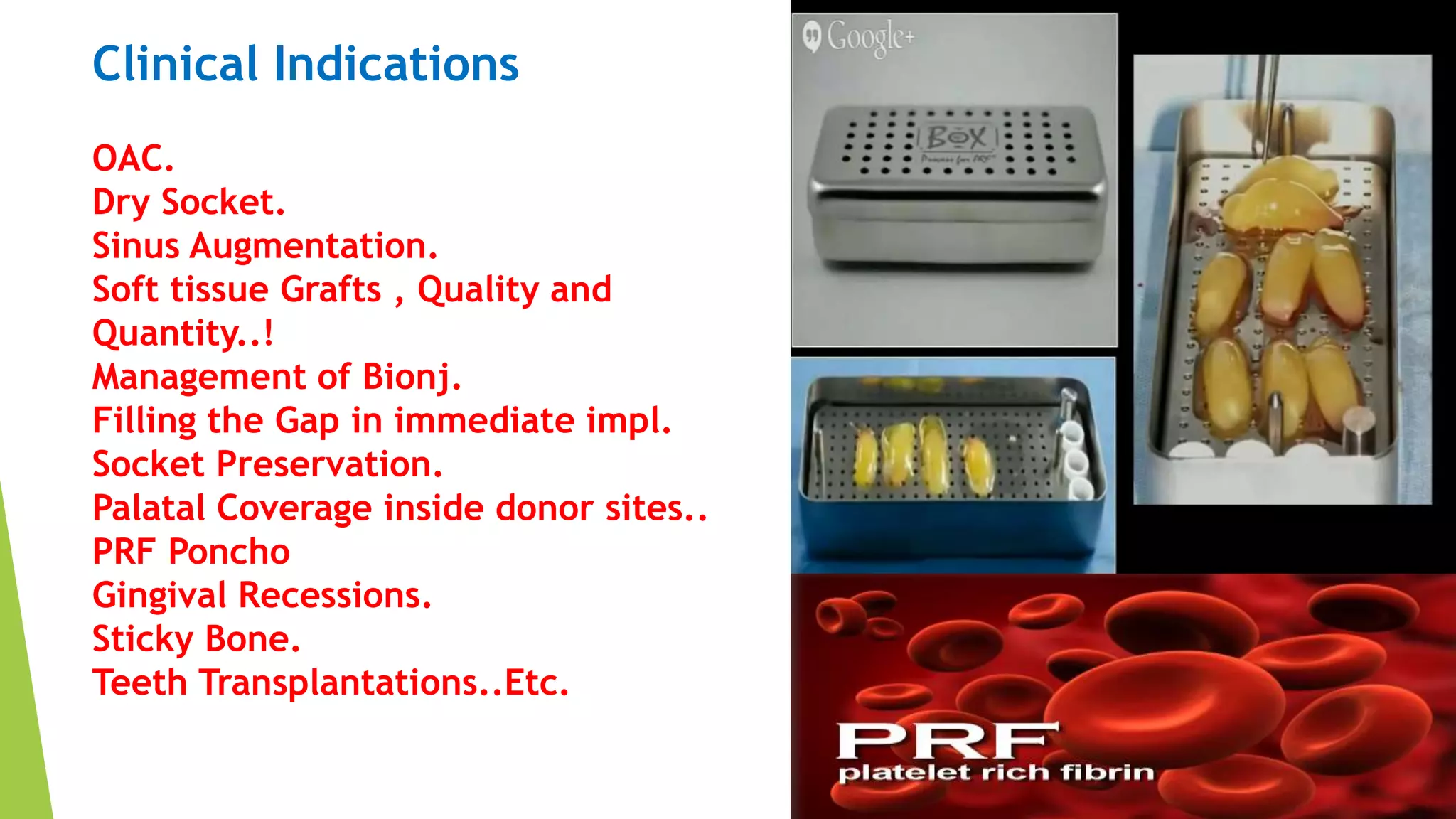 Platelet Rich Fibrin | PPTX
