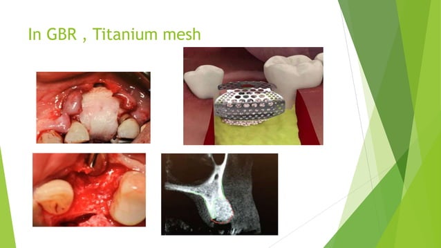 Platelet Rich Fibrin (PRF) | PPTX