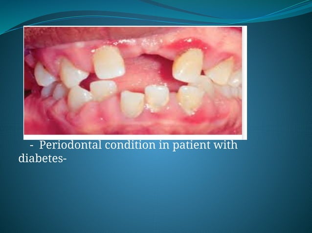RISK FACTORS FOR PERIODONTAL DISEASE.pptx