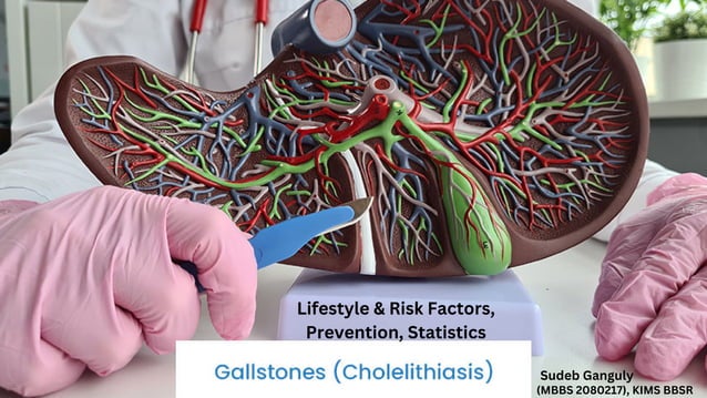Gallstones (Cholelithiasis) Lifestyle, Risk factors, preventions.pdf