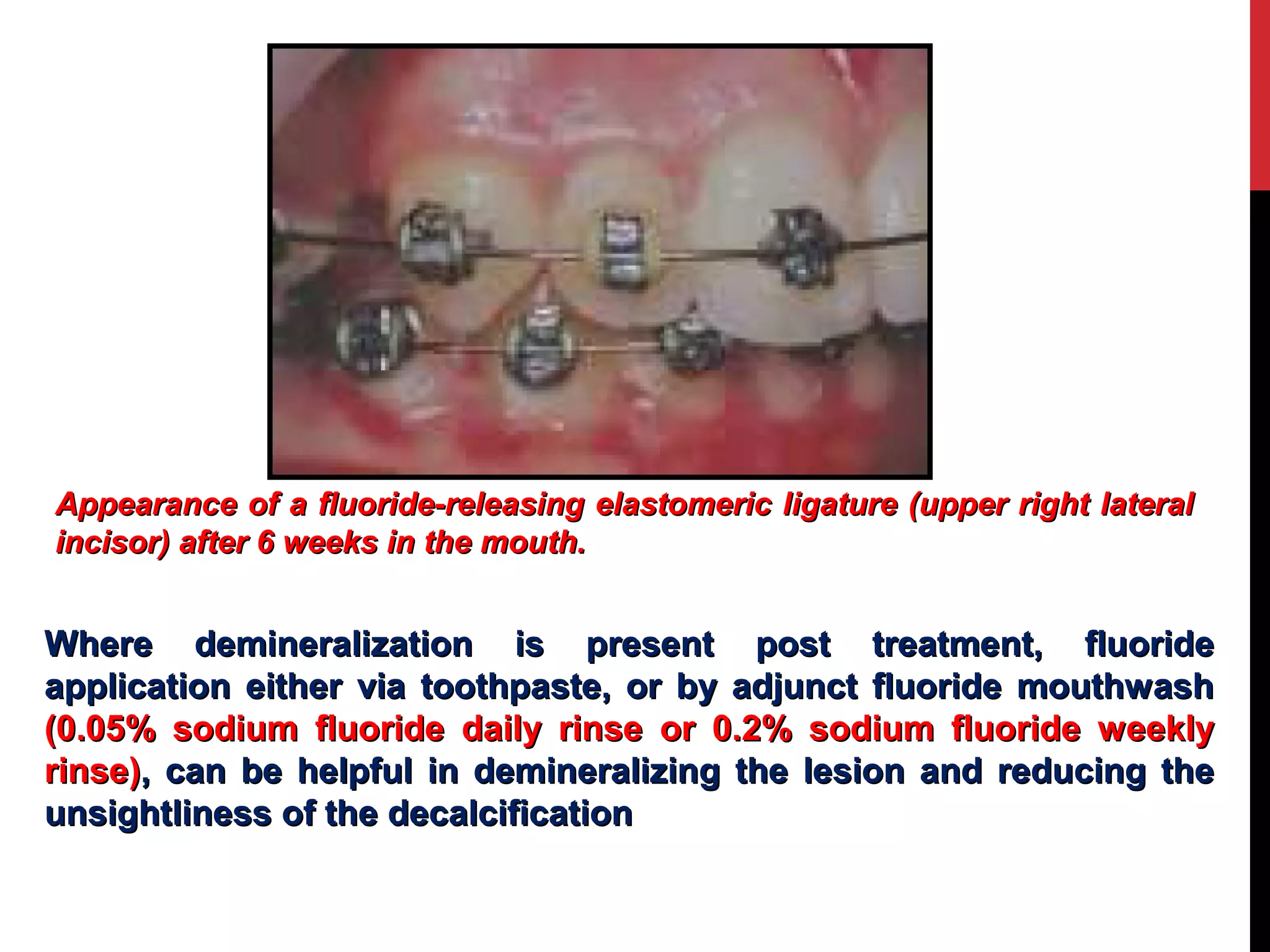 Risks in orthodontic treatment | PPT