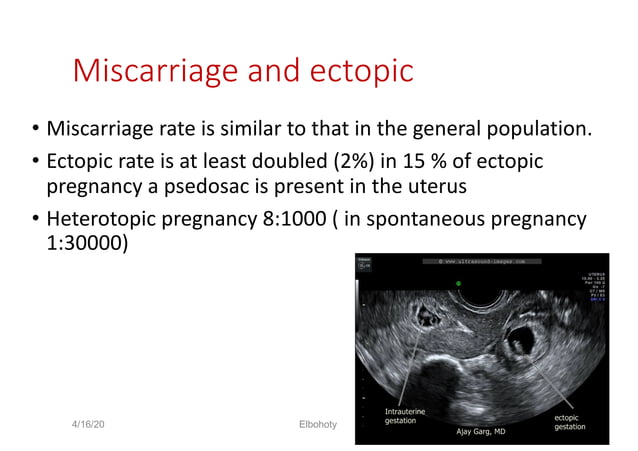 Risks of ivf | PPT | Free Download