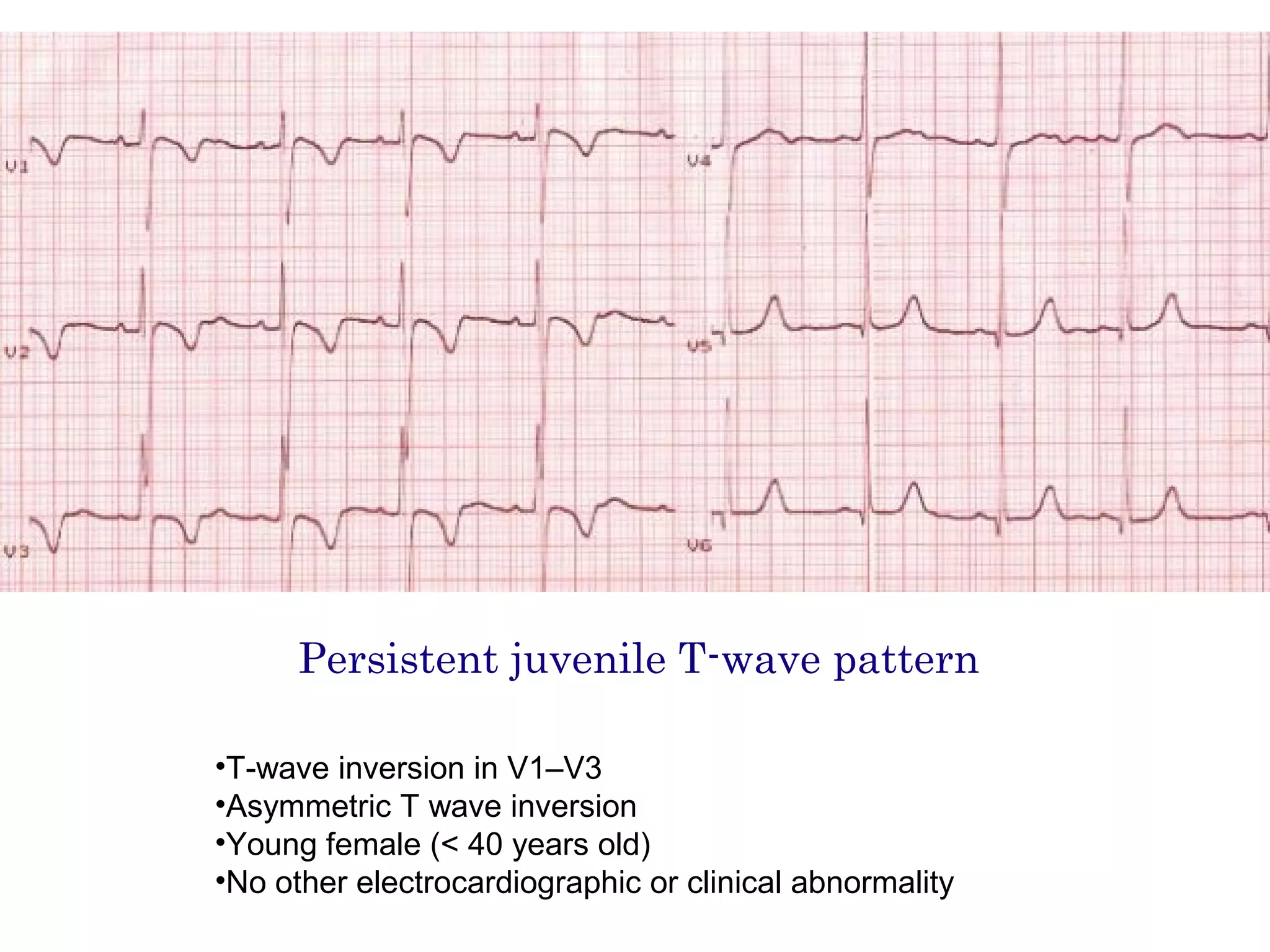 Risk stratification of UA & NSTEMI | PPT