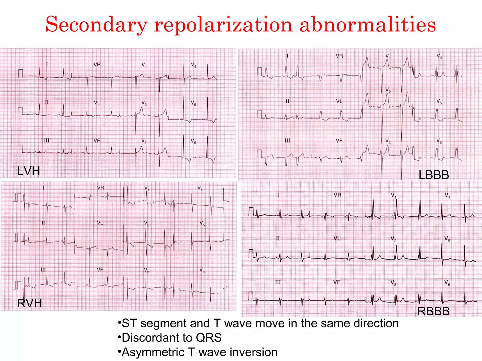 Risk stratification of UA & NSTEMI | PPT