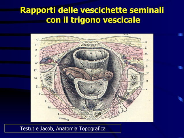 Risparmio vescicole seminali nella prostectomia radicale | PPT