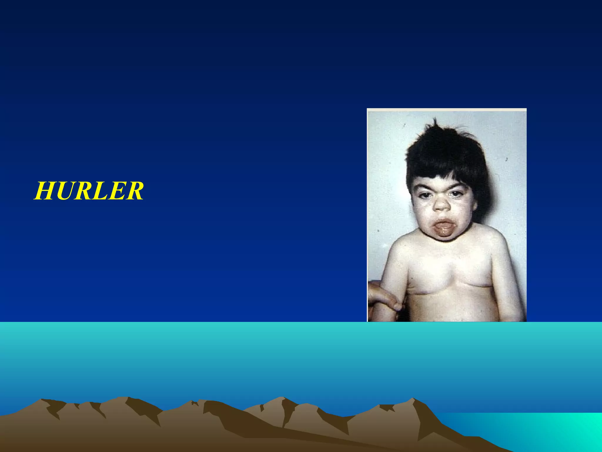 Ritardo mentale | PPT