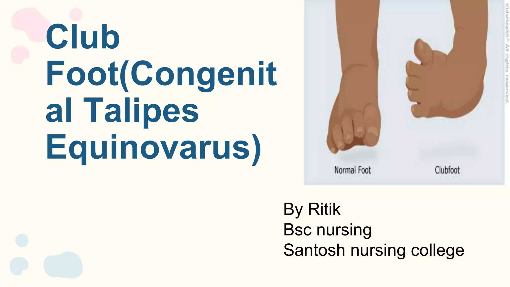 Club foot in Child | PPTX