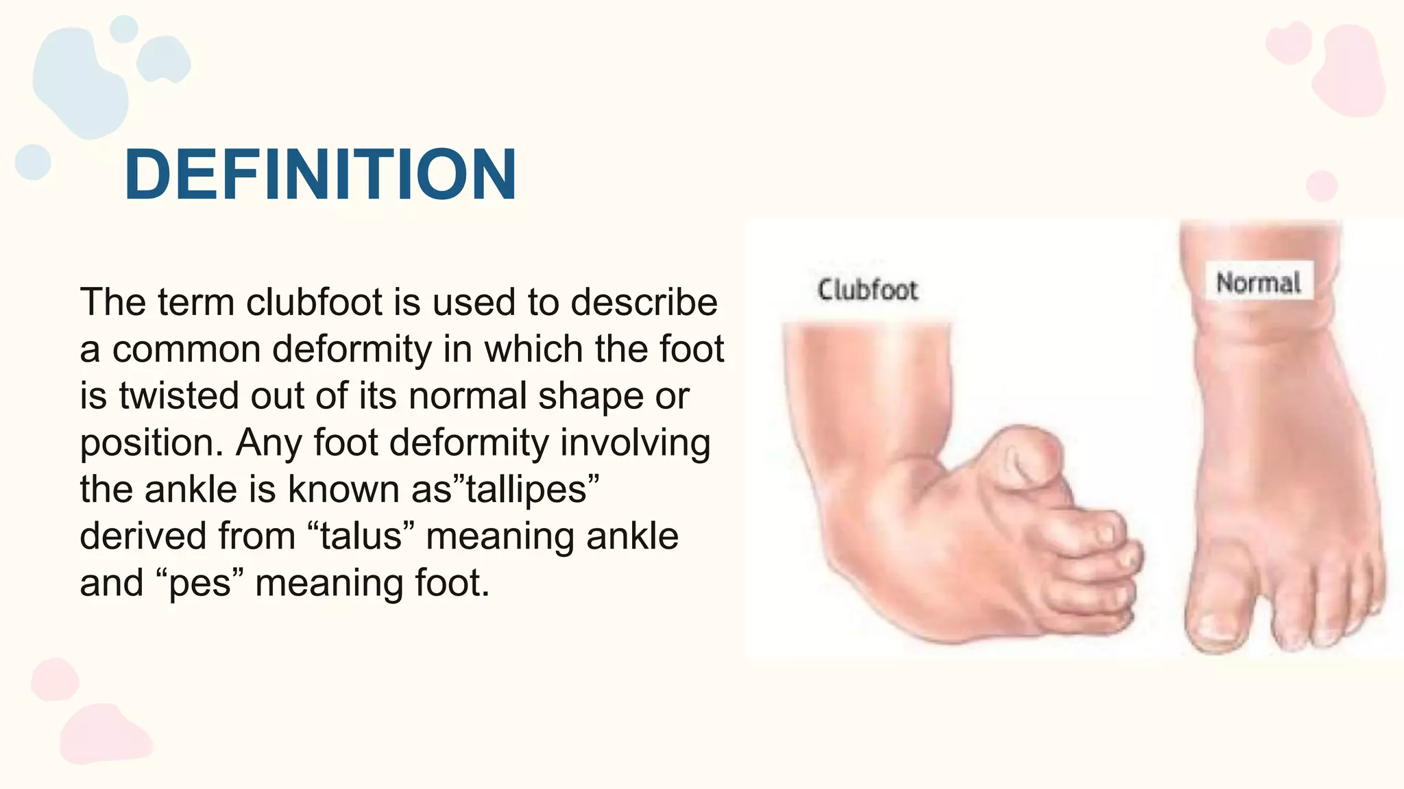 Club foot in Child | PPTX