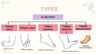 Club foot in Child | PPTX
